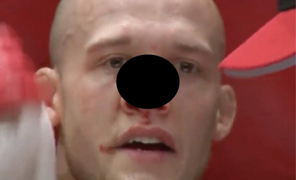 MMA Fighter Blake Perry Suffers Broken Nose - outkick | OutKick