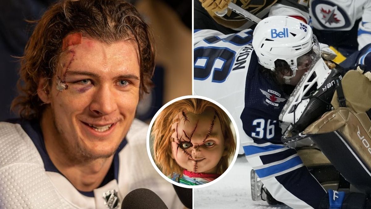 Jets’ Morgan Barron Shows Off Nasty Scars After Taking Ice Skate To The ...